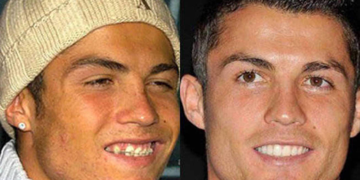 La prensa lusa muestra su preocupación por la obsesión al bótox de ...